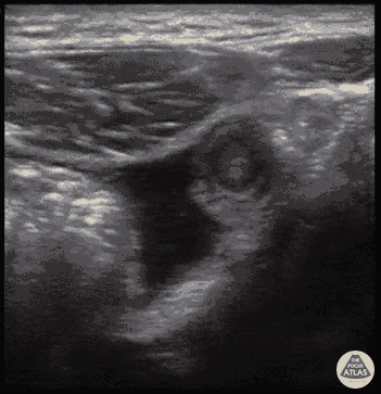 Appendicitis - WikEM