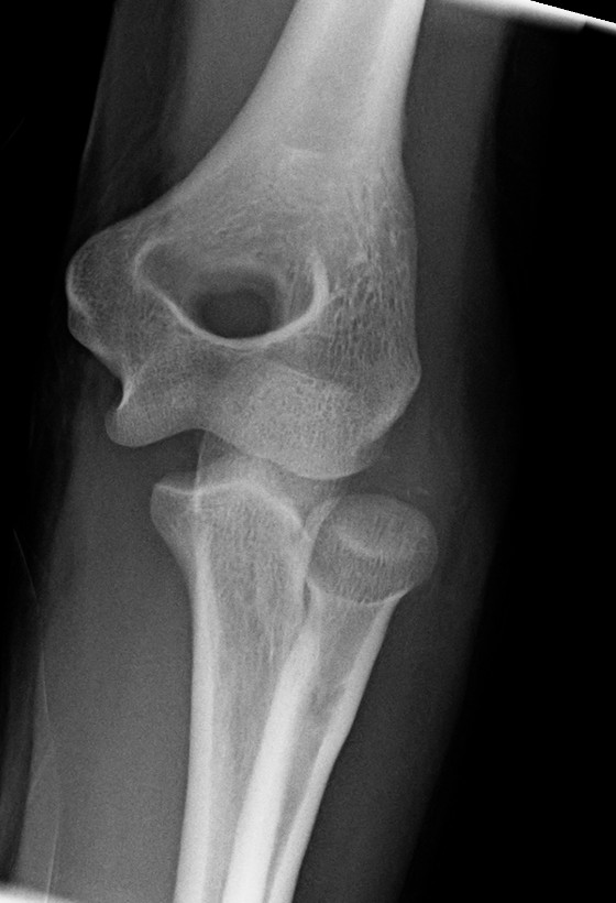 Elbow dislocation - WikEM