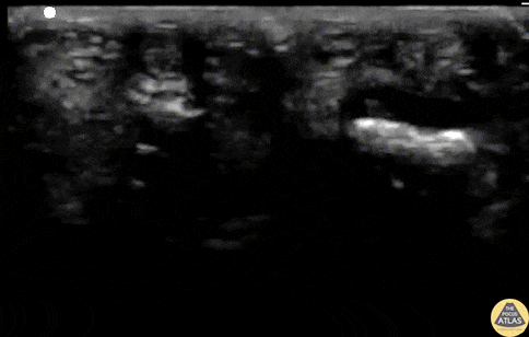 Flexor tenosynovitis - WikEM