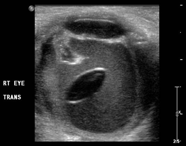 Lens dislocation - WikEM