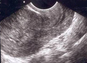 Pelvic ultrasound (transvaginal) - WikEM
