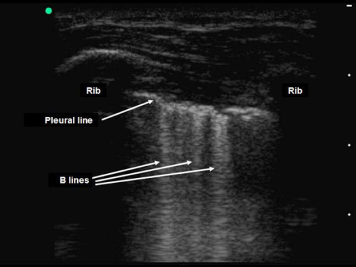 File:Lung sliding.png - WikEM
