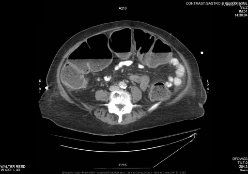 Toxic megacolon - WikEM