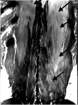 Compartment syndrome - WikEM
