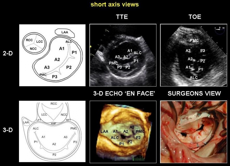 File:MV anatomy.jpg - WikEM