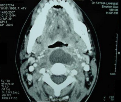 Retropharyngeal abscess - WikEM