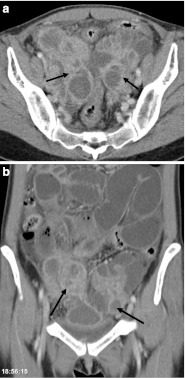 Pelvic inflammatory disease - WikEM
