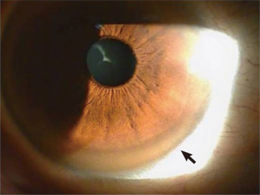 Wilson's disease - WikEM