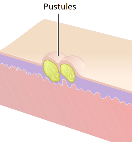 File:Pustules.png - WikEM