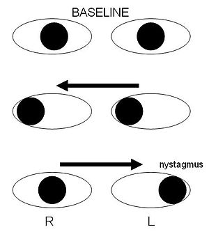 Internuclear ophthalmoplegia - WikEM