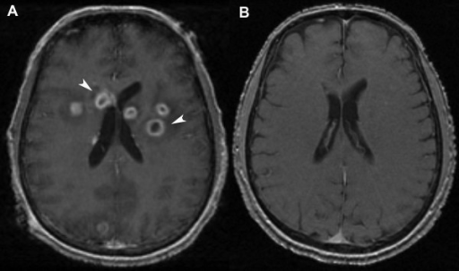 Ring-enhancing lesion - WikEM
