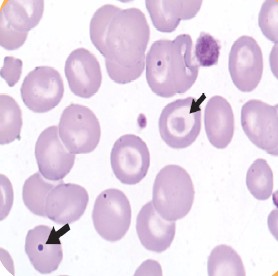 Asplenic patient - WikEM