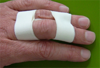 Buddy tape splint - WikEM