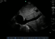 IVC ultrasound - WikEM