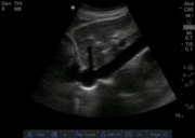 IVC ultrasound - WikEM