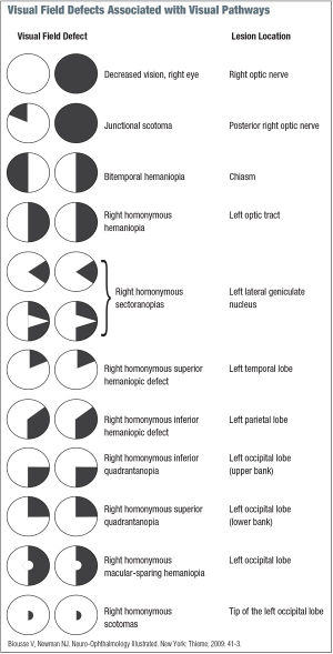 Visual field defects - WikEM